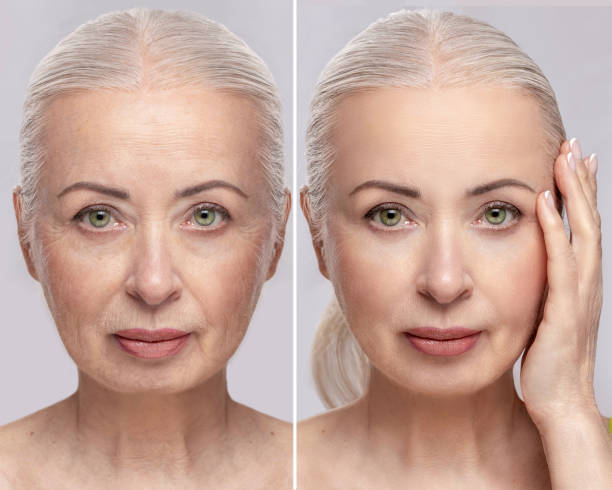 Face lift without surgery
